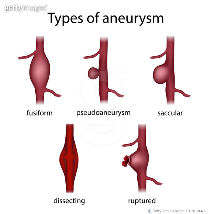 1191006439 | 게티이미지코리아 | Types of aneurysm, illustration Royalty-Free 이미지