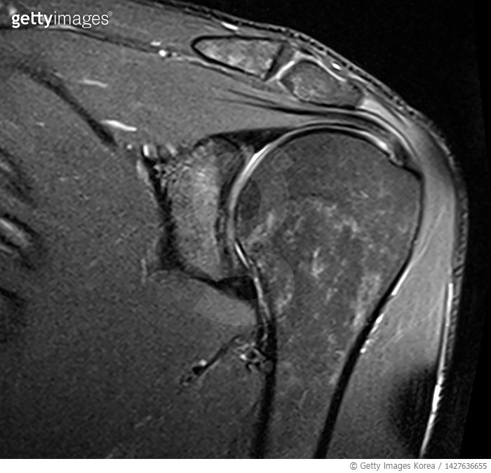 1427636655 | 게티이미지코리아 | Coronal PD FatSat left shoulder MRI image show ...